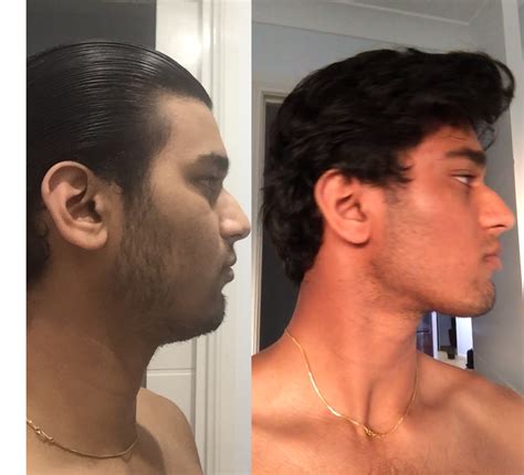 Does Chewing Gum Help Jawline? Before & After Chewing Falim Gum For a ...