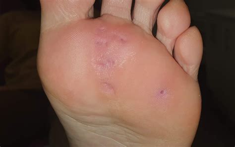 ¿Dónde encontrar tratamiento para el heloma plantar en la farmacia?