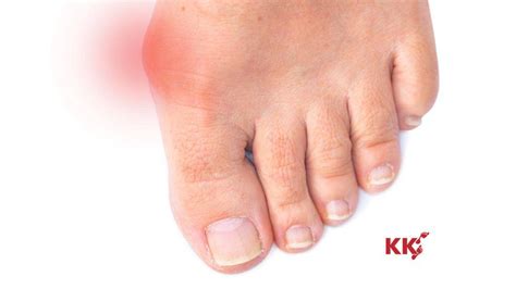 Der Hallux valgus - Fußorthopädie