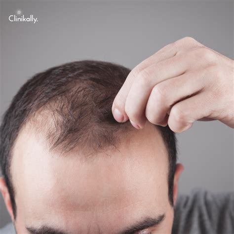 Redensyl for Hair Loss: Benefits, Side Effects & How to Use | Clinikally