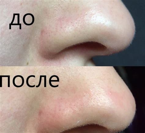 100% про LanBeNa Nose Plants Pore Strips — как пользоваться маской для ...