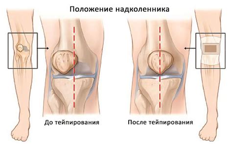 Тейпирование коленного сустава: что это, как работает, показания к ...
