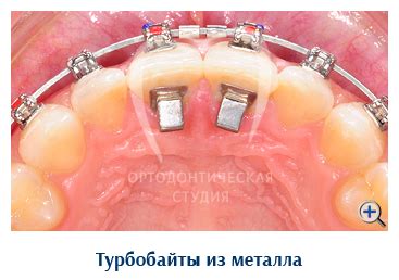 для чего нужны пружинки в брекетах