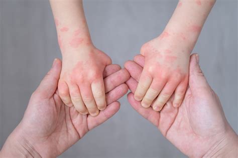 Tapinarof cream 1% reduces itch as early as 24 hours after application ...