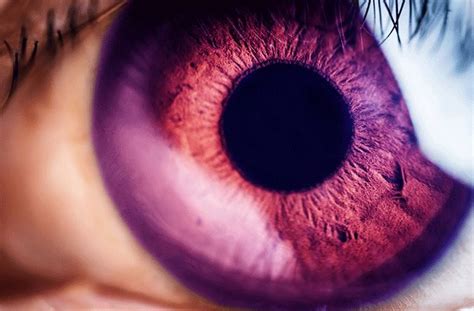 Violet Eyes Disease