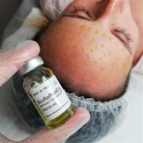 Пилинг биоревитализант biorepeel, цена процедуры в Москве - лечение в ...