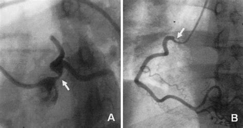 Aortitis | Circulation
