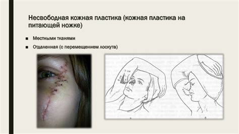 Способы пластического замещения дефектов кожи - online presentation