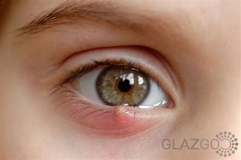 Ячмень: причины заболевания, симптомы, лечение и профилактика 【GlazGo】