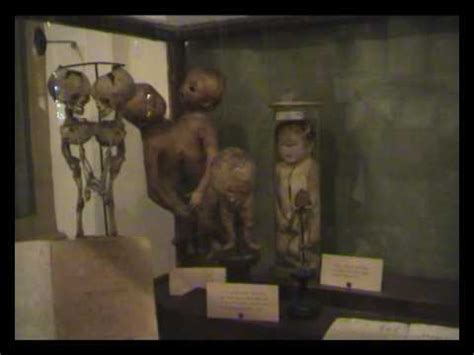 Strane Creature - Museo per la Storia dell'Università - Gemelli siamesi ...