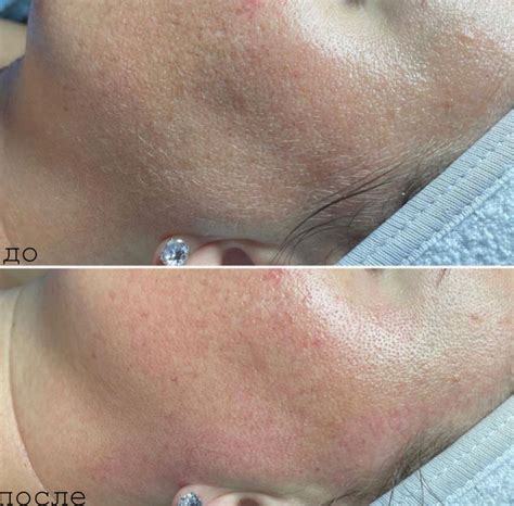 Обучение процедуре Dermaplaning - Дермапланинг: официальный сайт