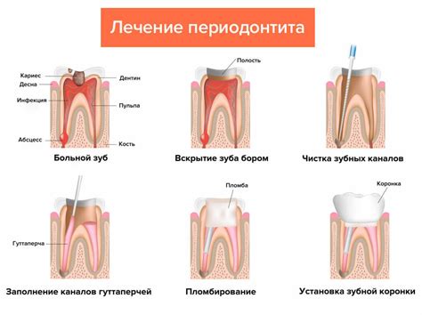 Периодонтит зуба. Причины, виды, симптомы, лечение, профилактика