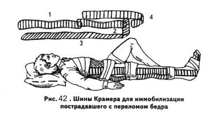 Студопедия — ТРАНСПОРТНАЯ ИММОБИЛИЗАЦИЯ