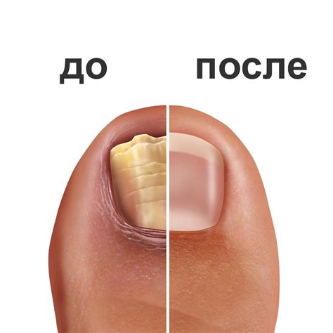 Экзин 2.0 лосьон капли от грибка ногтей - купить с доставкой по ...