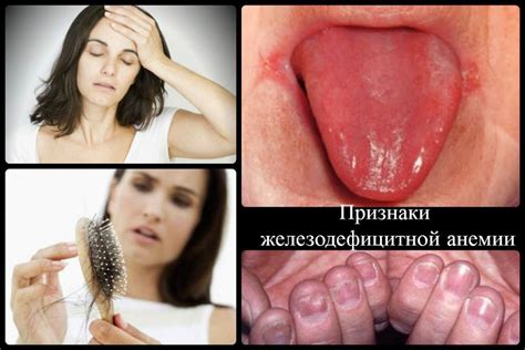 Железодефицитная анемия - симптомы, диагностика, лечение, клинические ...