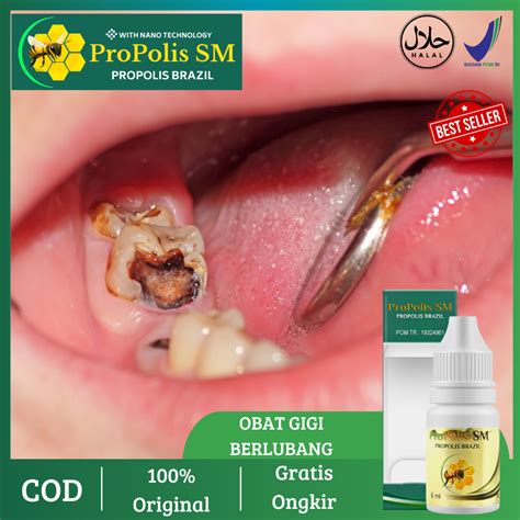 Jual Obat Kumur Gusi Bengkak Sakit Gigi & Karang Gigi Propolis SM ...