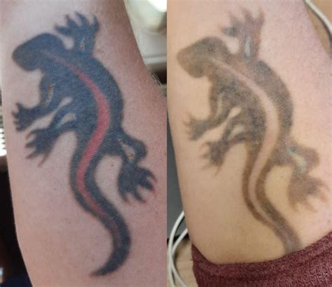 1333 best r/tattooremoval images on Pholder | Halfway progress. Pretty ...
