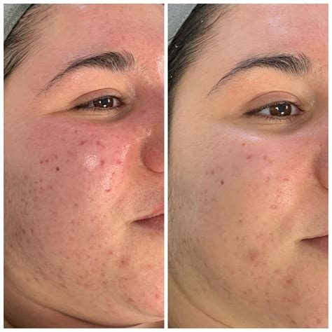 BioRePeel Treatments | Corsham Bath Wiltshire
