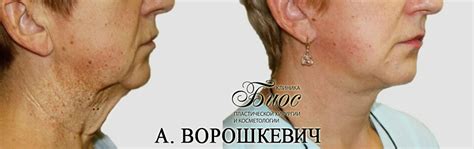 Липосакция подбородка