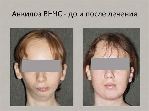 Острая травма ВНЧС у детей. Отдаленные последствия травмы ВНЧС ...