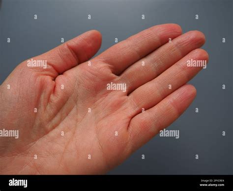 Weibliche Hand mit trockener atopischer Haut. Weißer Hintergrund ...