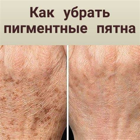 Как избавиться от пигментных пятен на руках