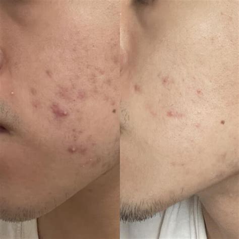 LAURITZ 10% Potassium Azeloyl Diglycinate Acne Control Serum