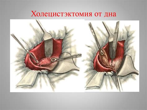 Острый холецистит - презентация онлайн