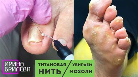 Установка Титановой нити NiTi (коррекционная система) 🌸 Склонные к ...