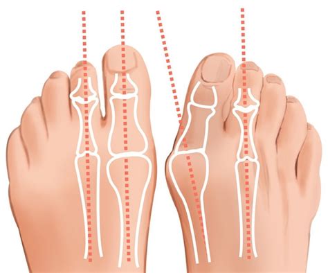"КОСТОЧКА" НА НОГАХ Так обычно называют Hallux Valgus. Это вальгусная ...