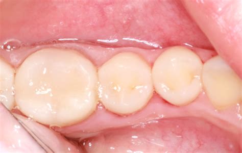 Пломбування зубів - Tomchuk Dental