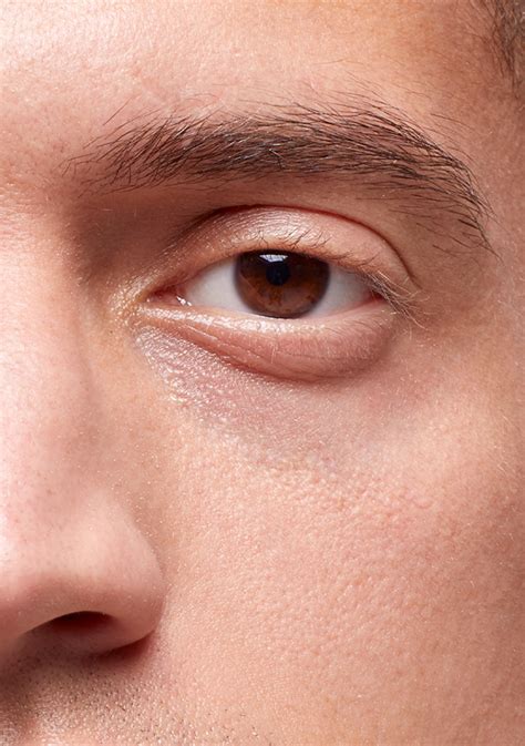 eye bags - Dr. Omar Haroon - The Journey of the Face