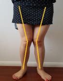 Valgus - Definition and Examples - Biology Online Dictionary