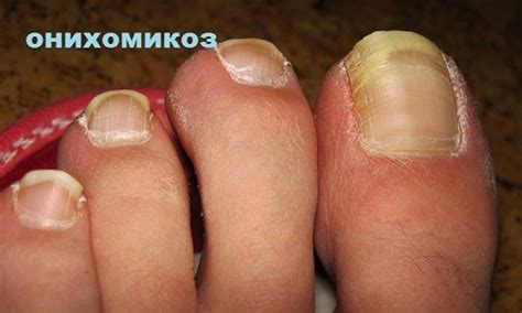 Как правильно использовать Экзостат от грибка? – Медицинский портал