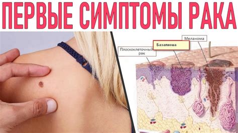 ПРОВЕРЬ СЕБЯ НА РАК | 5 способов проверить себя на онкологию - YouTube