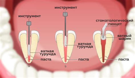 Обтурация корневых каналов: современные методы в эндодонтическом лечении