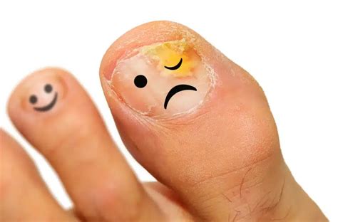 Fungal Nail Treatment: Nail Fungus & Fungal Nails Solutions