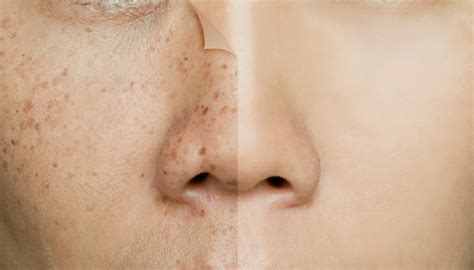 Freckless? Your Official Guide to Freckles Removal in Singapore