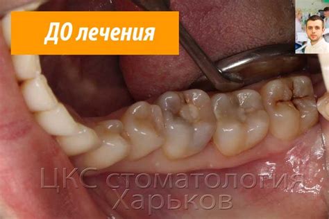 Устанавливайте правильные зубные пломбы
