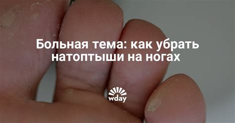 Чем и как убрать натоптыши на ногах — www.wday.ru