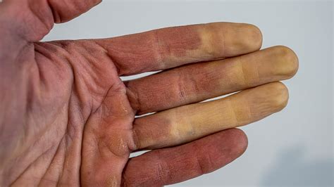 Fingers Turn Blue or White When Cold? It Could be Raynaud’s ...