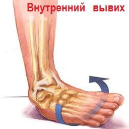 Вывих голеностопа - 4 симптома, первая помощь и лечение