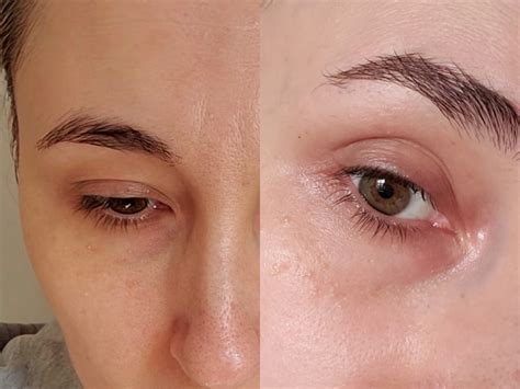 Патчи L.sanic Hyaluronic Acid на один раз: Wow-Эффект или кот в мешке ...