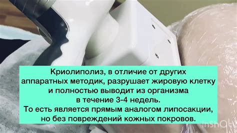 КРИОЛИПОЛИЗ. Как проводится процедура - YouTube
