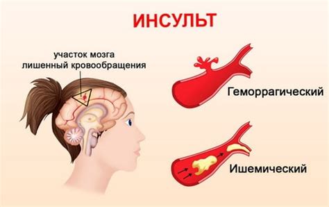 Почему после инсульта человек много спит