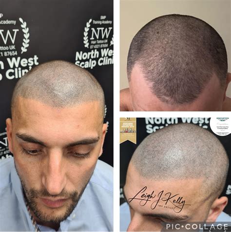 Gallery - North West Scalp Clinic