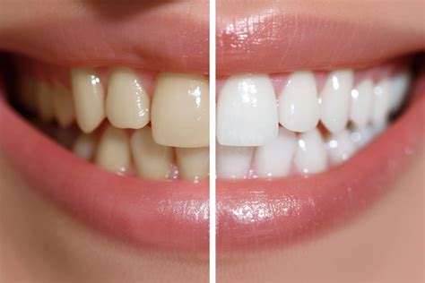 Система Amazing White Amazing отбеливание зубов в Люберцах