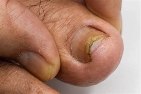 Fungal Nail Treatment Albany | Advanced Family & Sports Podiatry