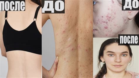 Как я избавилась от прыщей (АКНЕ), постакне на СПИНЕ И ЛИЦЕ |Мой опыт ...