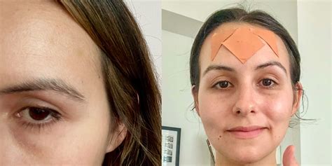Botox Vs Face-Taping to Smooth Forehead Wrinkles - Business Insider